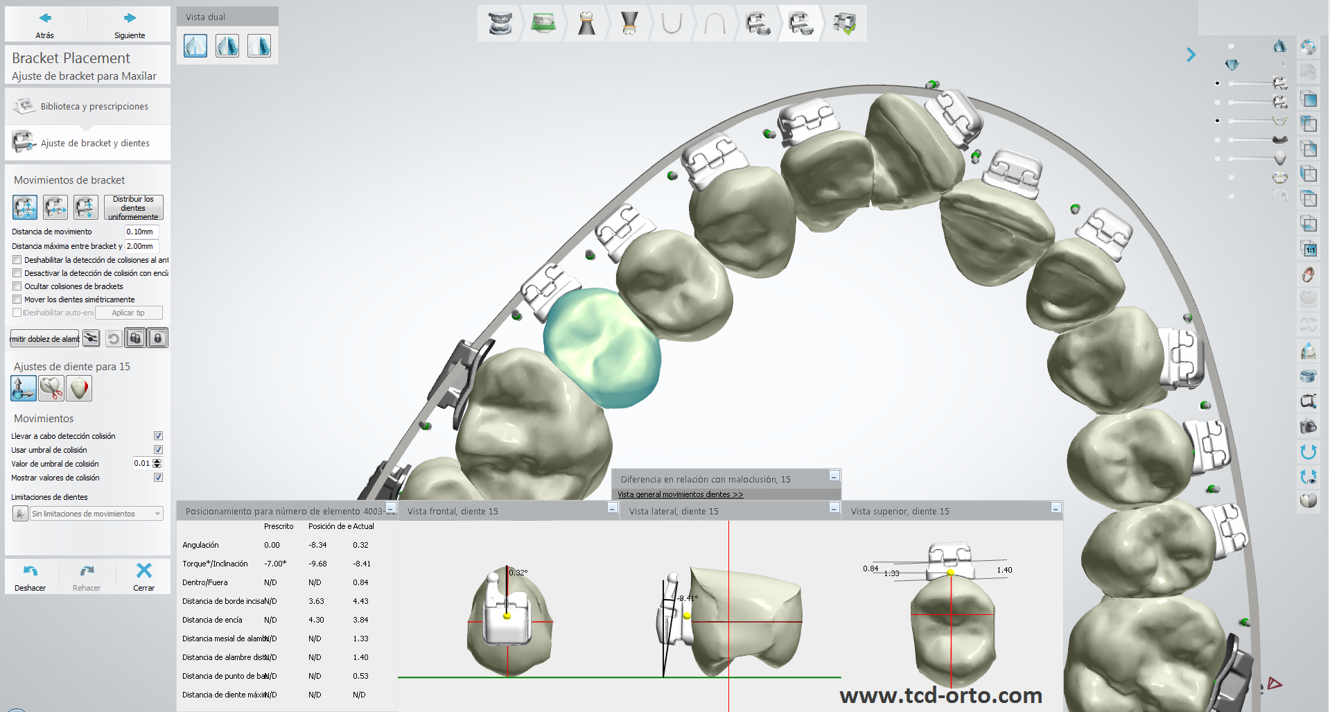 Nuevo curso de cementado indirecto en Madrid - TCD ORTODONCIA